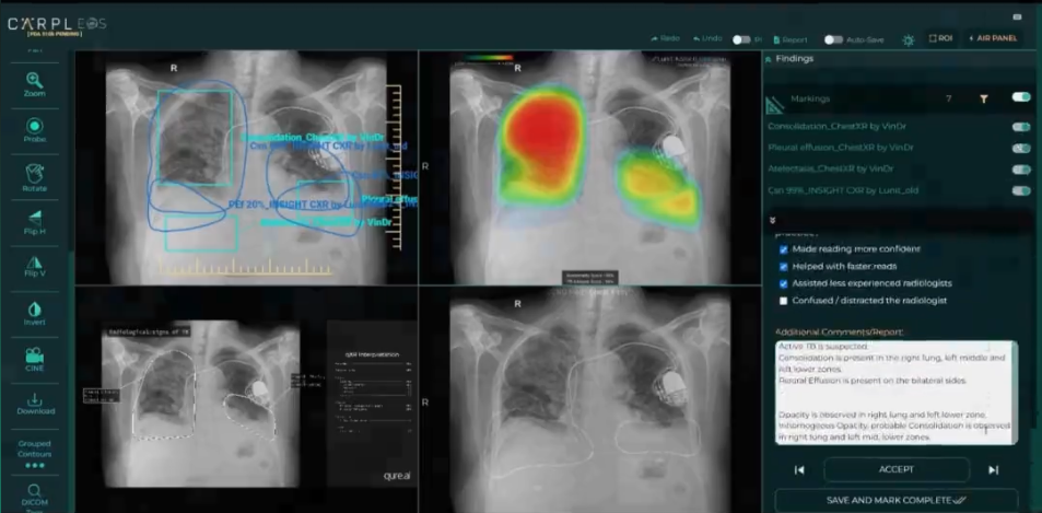 BrainX Community Live! May 2024: Business lessons from implementing AI platform in Radiology ...